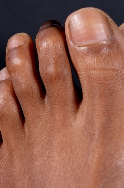 Crooked Toes and Selecting the Right Shoes | New York, NY